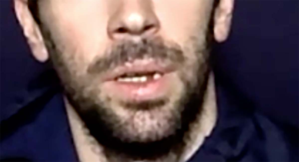 Justin Schultz lost several teeth and fractured several others ...
